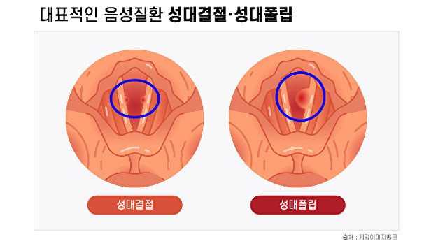 Recognizing And Treating Vocal Cord Nodules And Polyps What You Need 2322
